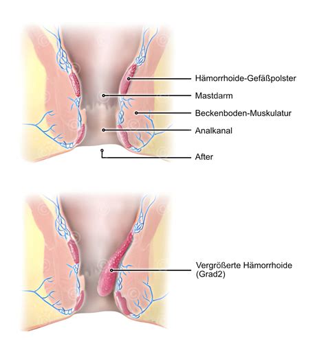 Illustration Hämorrhoiden MedicalGraphics