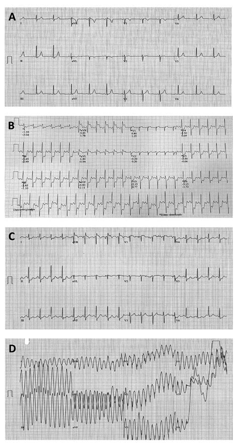 Electrocardiographic Assessment At Baseline And Follow Up A Baseline