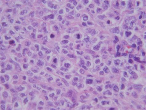 Case 2 Biopsy Histological Section Shows Large Mononuclear Cells Download Scientific Diagram