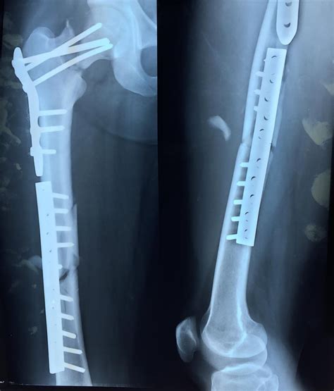 Left Femoral Neck Fracture Maleaslo