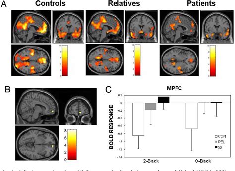 Figure 1 From Hyperactivity And Hyperconnectivity Of The Default