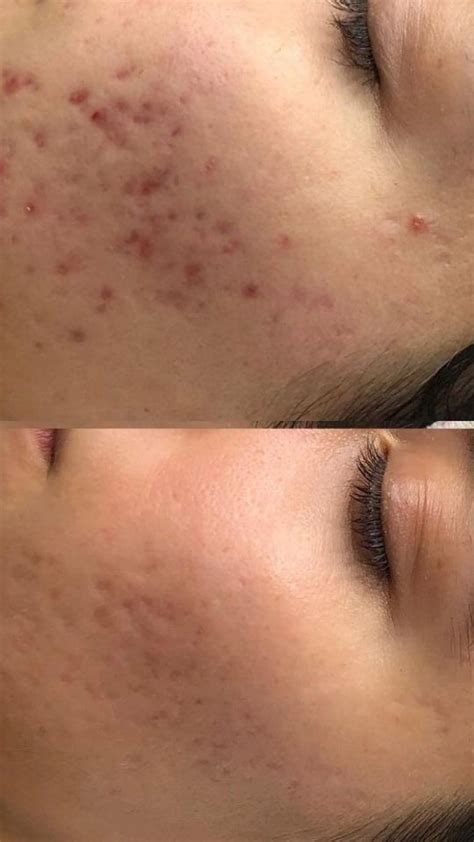 ОНЛАЙН ПОДБОРДОМАШНЕГОУХОДА МИНСК ГУБЫ БОТОКС ЛЕЧЕНИЕ АКНЕ Господи благодарю за эти моменты