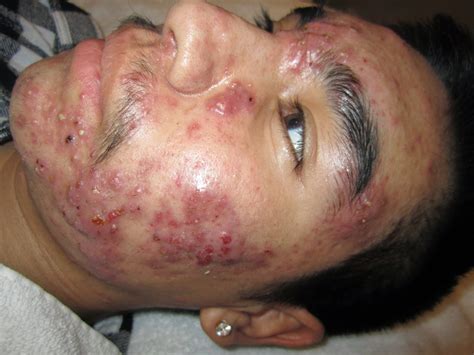 Staph Infectioncommonly Mistaken For Acne Skintherapy