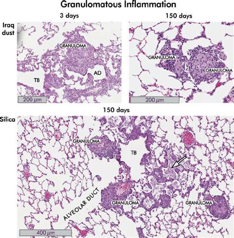 Granulomatous Inflammation In The Lungs Of Rats Instilled With Iraq And