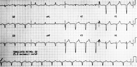 A Novel Variant Of Transthyretin 59thr→lys Associated With Autosomal Dominant Cardiac