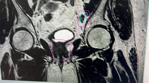 dr jay upadhyay on linkedin lymph node tracking on mr linac in the