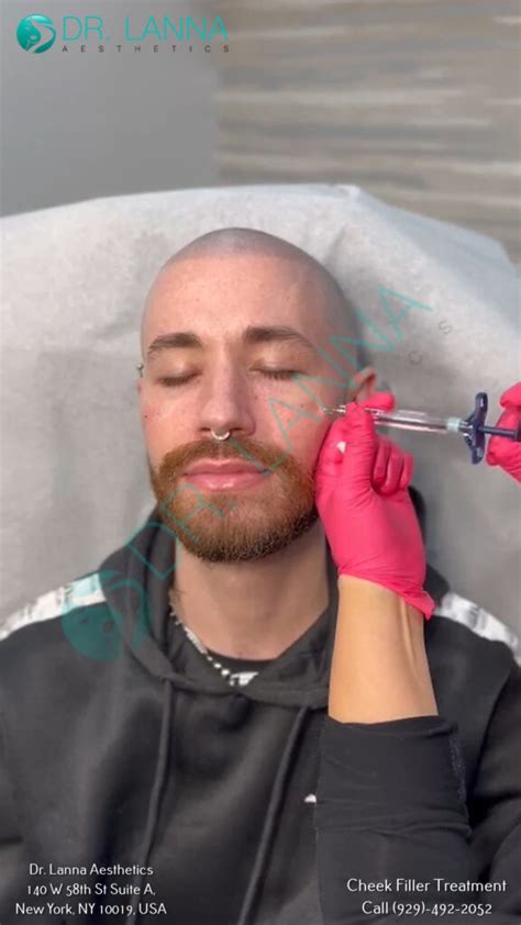 Basics Of Cheek Filler Marking Techniques Doctor Lanna