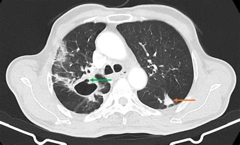 Bronchoscopic View Of Post Tuberculosis Lung Cavity