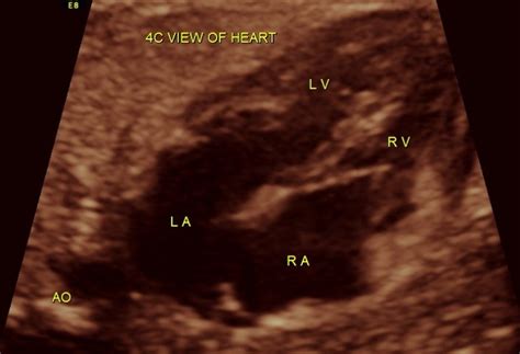 Ostium Secundum Atrial Septal Defect Looking Through A Transducer
