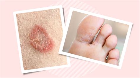 Pinworm Rash On Face