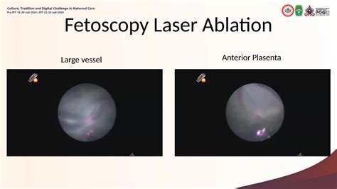 Ttts Pregnancy Intervention Stage 1 2 Final Pptx
