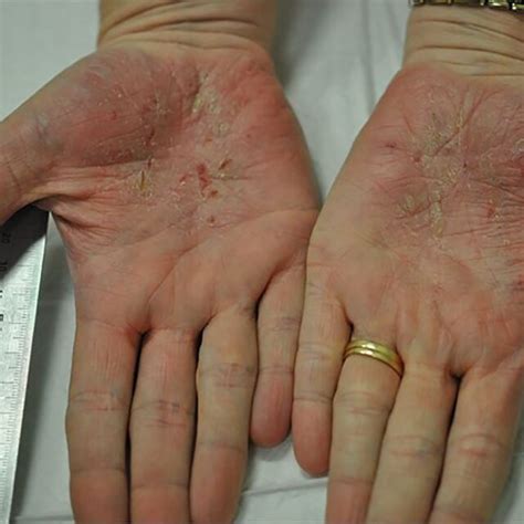 12 Months Post‐treatment Plantar Psoriasis Download Scientific Diagram