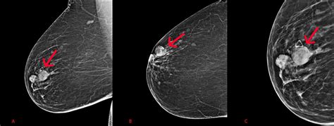 Mediolateral Oblique A And Craniocaudal B Mammogram Of The Right