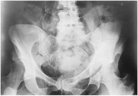 Radiographic Artifacts Radiology Key