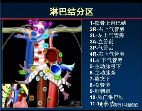 肺癌的第九版分期 知乎