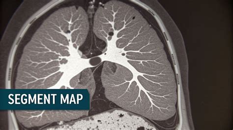 Effective Lung Segments On Ct A Practical Guide Pycad Your Medical