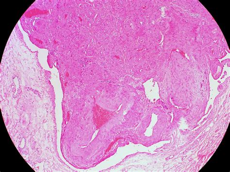 Angiomyoma Deep Dermis Temporal Area Ed Uthman Flickr