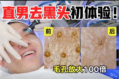 直男清理黑头初体验！凤凰网视频凤凰网