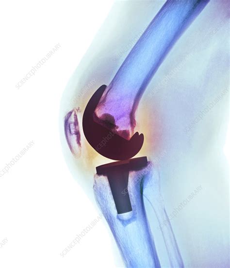 Knee Replacement X Ray Stock Image F Science Photo Library