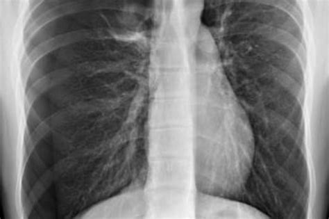 Tràn Khí Màng Phổi Nguyên Nhân Triệu Chứng điều Trị