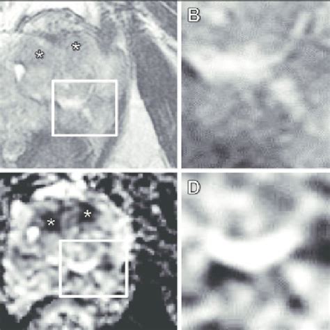 Conversion Table Of The Anatomic Prostatic Mri Zones Pi Rads Mapping Download Table