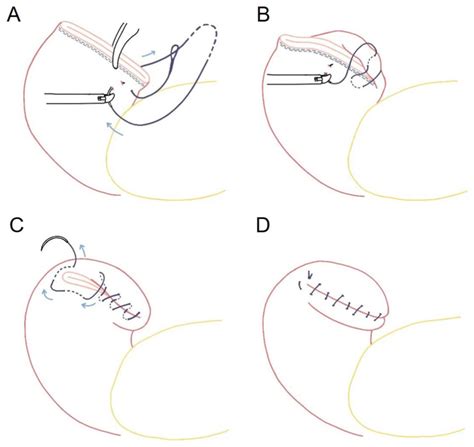 Reinforcement Methods Of Duodenal Stump After Laparoscopic Gastrectomy For Gastric Cancer A