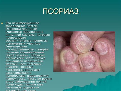 Базовый курс по педикюру Микоз Вросший ноготь урок 5 презентация
