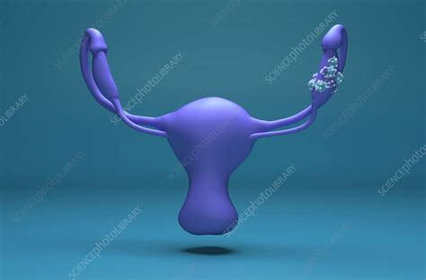 Ovarian Cancer Illustration Stock Image F0438349 Science Photo