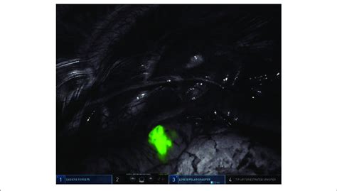 Pulmonary Nodule In The Left Upper Lobe Illuminated By Icg Download Scientific Diagram