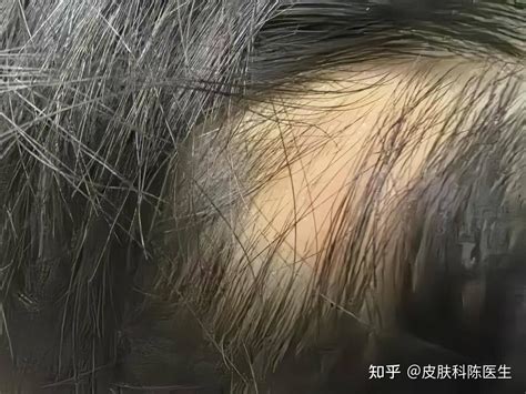 斑秃从发病原因到治疗及自我管理的全面指南 知乎