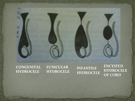 Hydrocele