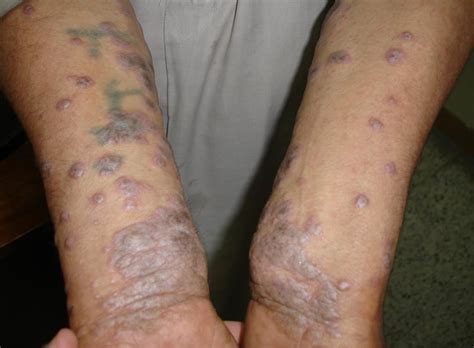 Lichen Planus Causes What It Looks Like And How To Get Rid Of It