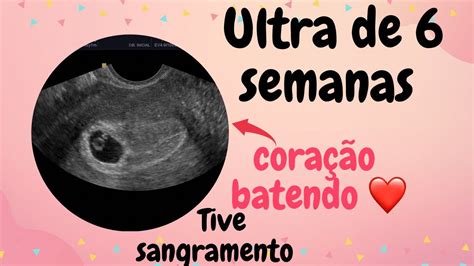 Ultrassom De 6 Semanas Conseguimos Ouvimos O Coração Do Bebê Fiv