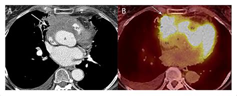Figure 2 From Imaging Evaluation Of Thymoma And Thymic Carcinoma