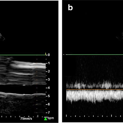 Measurement Of Ivc By Ultrasound With The Cardiac Probe A M Mode Image