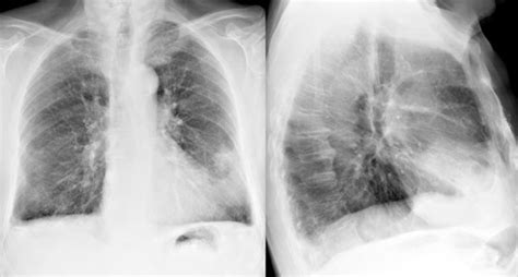 Left Lingular Infiltrate