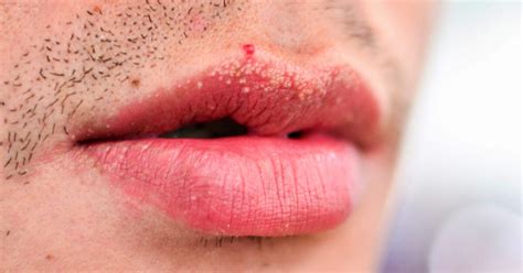 Why Have I Got Spots On My Lips