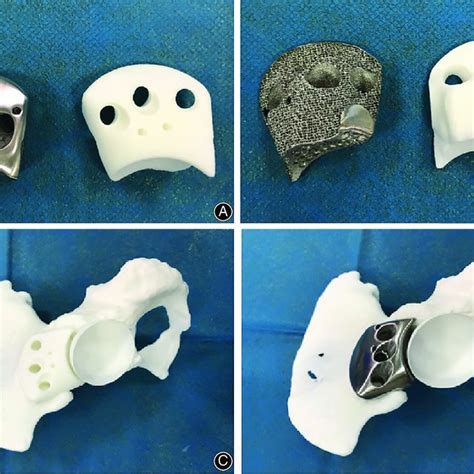 The 3d Printed Porous Augment Was Clinically Applied In A Patient With