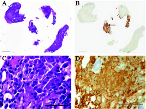 Immunohistochemistry Of Resected Pituitary Tissue Using An Anti Acth