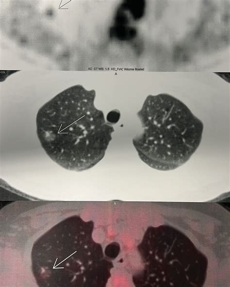 Beleza De Segmentectomia Anatômica Com Estudo 📖 Pré Operatório Da