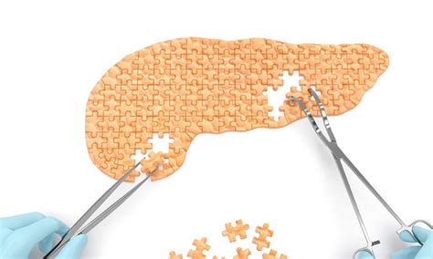 Por qué todavía es difícil conseguir un páncreas artificial en España Noticias en Salud