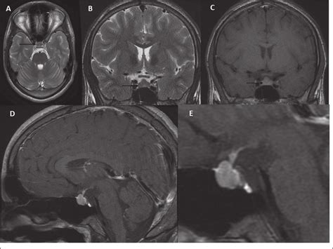 Magnetic Resonance Imaging Of The Brain T2 Weighted Axial A And