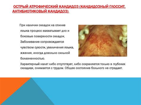 Кандидоз полости рта у детей презентация онлайн