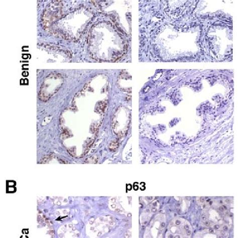 α2β1 Integrin Expression In Prca α2β1 Integrin Immunostaining Was