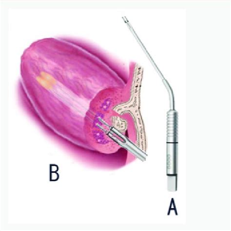 Bipolar Needle Caurtey A And Inferior Turbinate Outfracture
