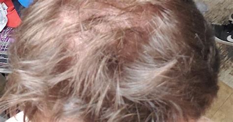 Thinning Hair Pre Finasteride Album On Imgur