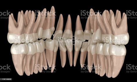 비정상적인 치아 위치 및 금속 중괄호 Tretament 의학적으로 정확한 치과 3d 일러스트레이션 금속에 대한 스톡 사진 및 기타 이미지 Istock