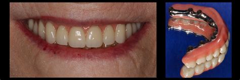 Maxillary Removable Partial Denture