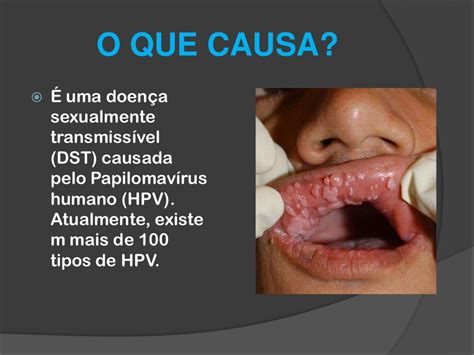 Periodo De Incubação Hpv Librain