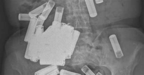 아일랜드 여성 뱃속에 건전지 55개가 대체 왜 삼켰나